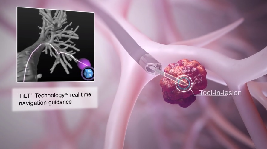 Noah Medical Lands $150M For Robotic Bronchoscopy - DailyAlts